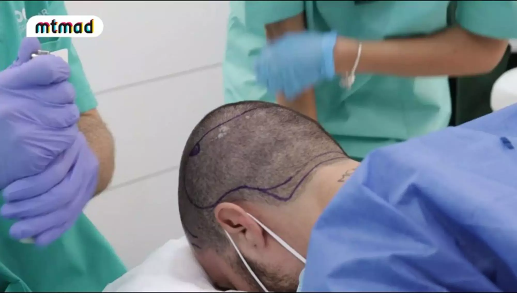 Алејаднро Бернардос, момчето на Мајка Ривера, од островот на искушенијата, прави трансплантација на коса и го покажува процесот и резултатот