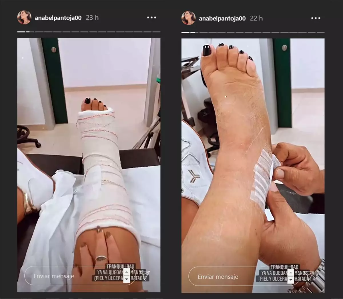 De foet fan Anabel Pantoja yn gips