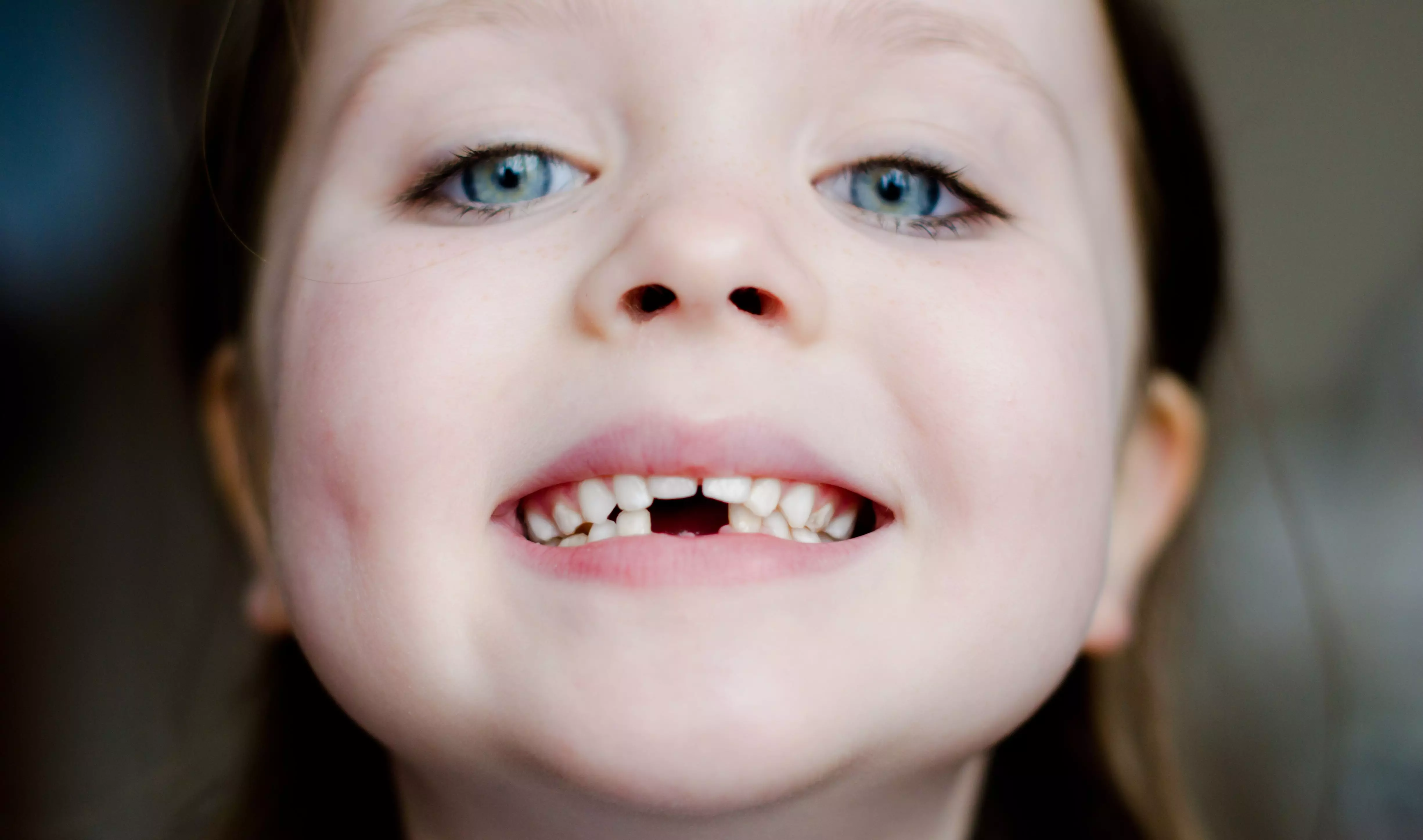 menina mostrando seus dentes de leite com uma lacuna no maxilar inferior